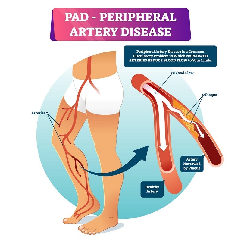 What is Peripheral Artery Disease (PAD)? | Bassett Healthcare Network
